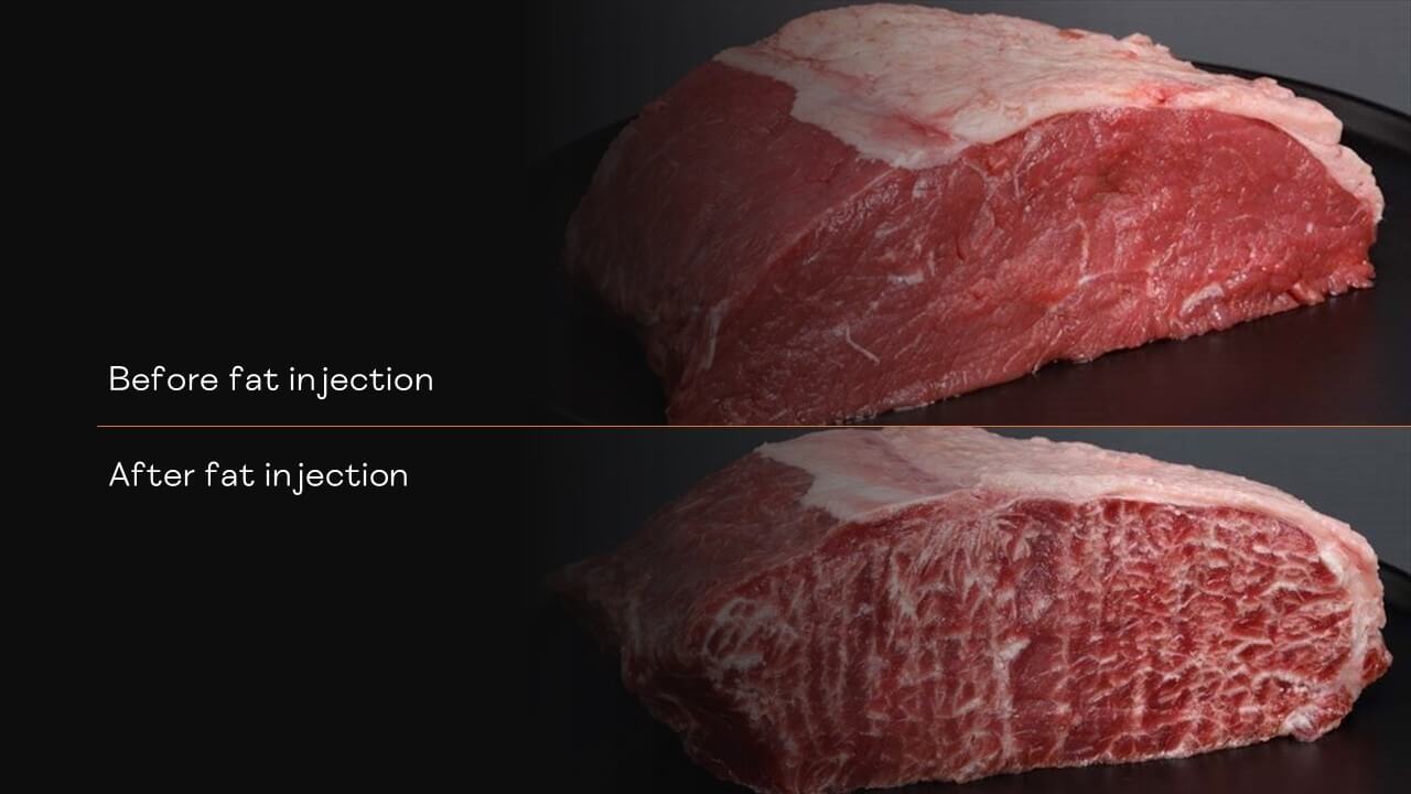 Discover our revolutionary fat injection technology and 5 other ...